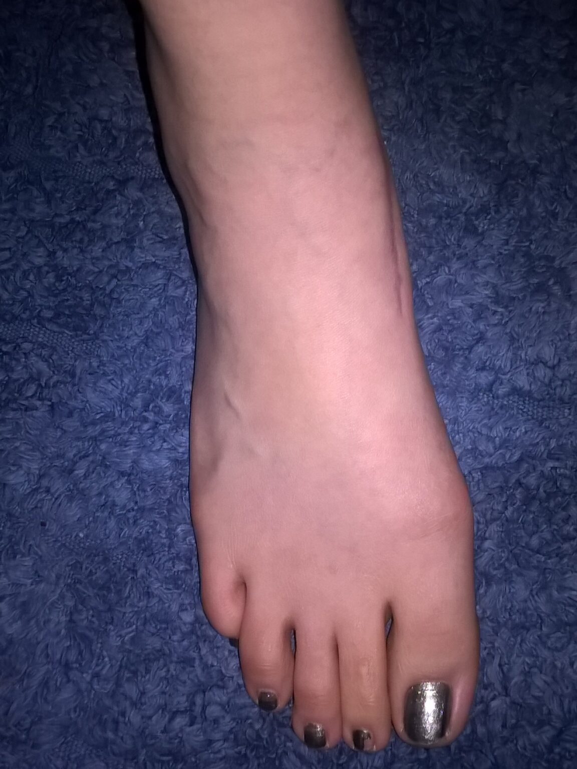 She had suffered from severe pain in one of her feet, as the bones had ...